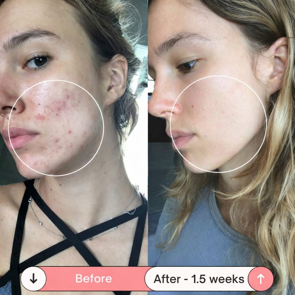 High-Frequency Facial Wand for Acne & Glow | Aura Beauty – aura beauty ...